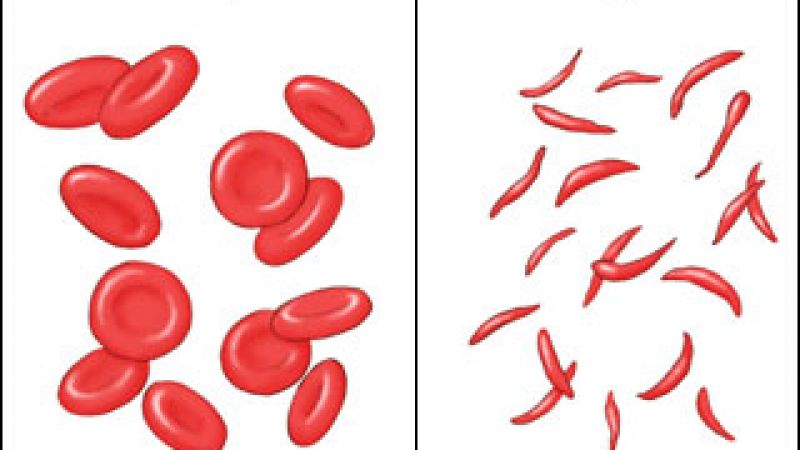 Sickle Red Blood Cell